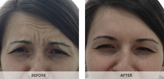 Dysport Injections by Expert Injector in the Bronx, Westchester, New ...